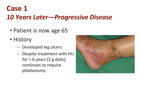 A Focus on Polycythemia Vera for Nurse Practitioners and Physician ...