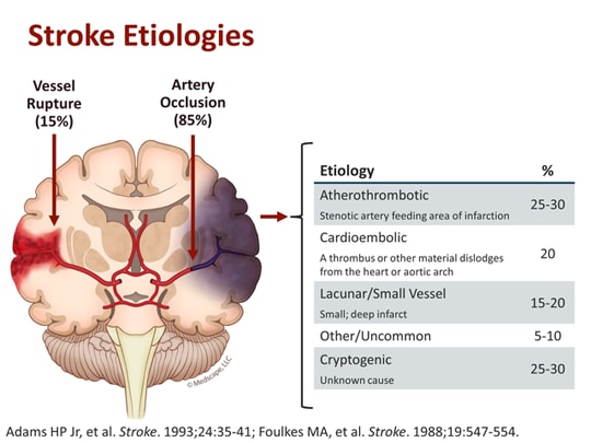 Taking the "Cryptogenic" Out of Cryptogenic Stroke (Transcript)