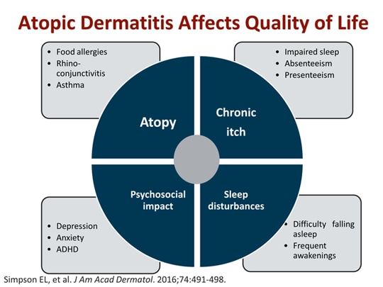 What's New in Atopic Dermatitis: Conference Coverage on the Latest ...
