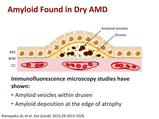 Dry AMD and GA: The Present and Future (Transcript)