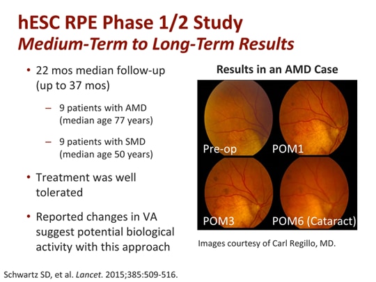 Dry AMD and GA: The Present and Future (Transcript)
