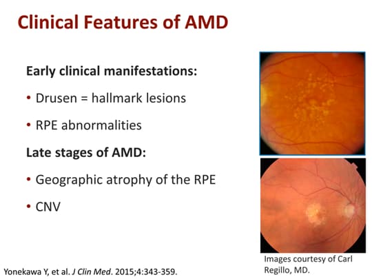 Dry AMD and GA: The Present and Future (Transcript)