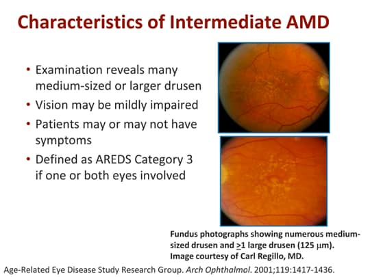 Dry AMD and GA: The Present and Future (Transcript)