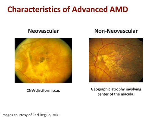 Dry AMD and GA: The Present and Future (Transcript)
