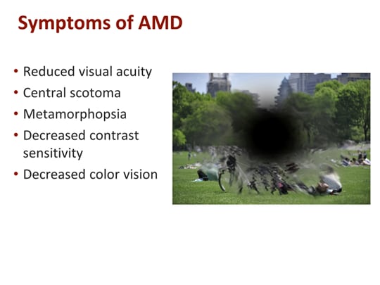 Dry AMD and GA: Where Are We Now, and Where Are We Going? (Transcript)