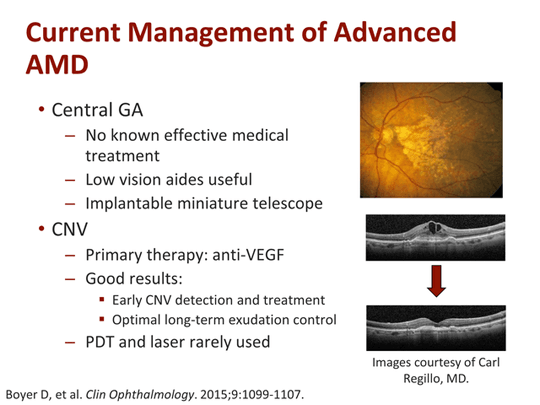 Dry AMD and GA: Where Are We Now, and Where Are We Going? (Transcript)