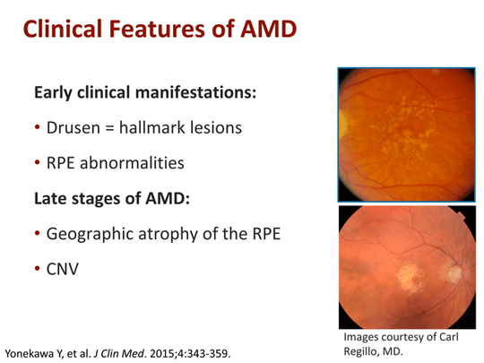 Dry AMD and GA: Where Are We Now, and Where Are We Going? (Transcript)