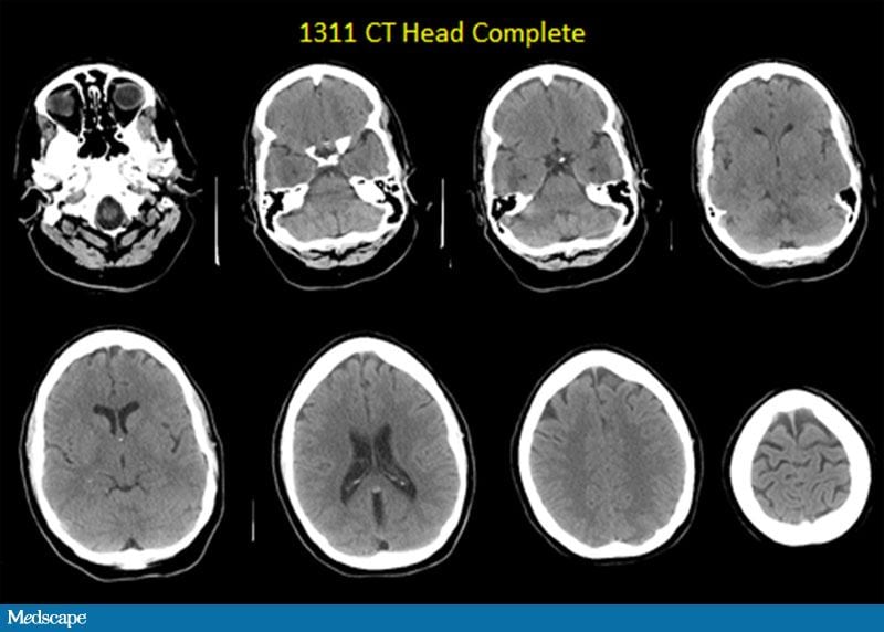 Current Approaches to the Management of Acute Ischemic Stroke