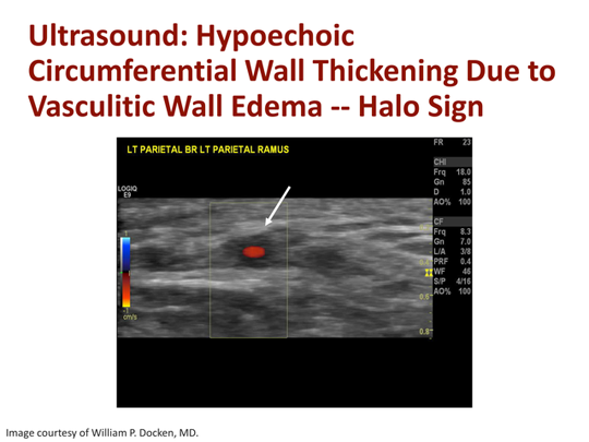 Giant Cell Arteritis: Timely Diagnosis and Emerging Treatment ...
