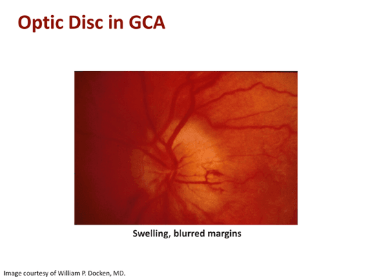 Giant Cell Arteritis: Timely Diagnosis and Emerging Treatment ...