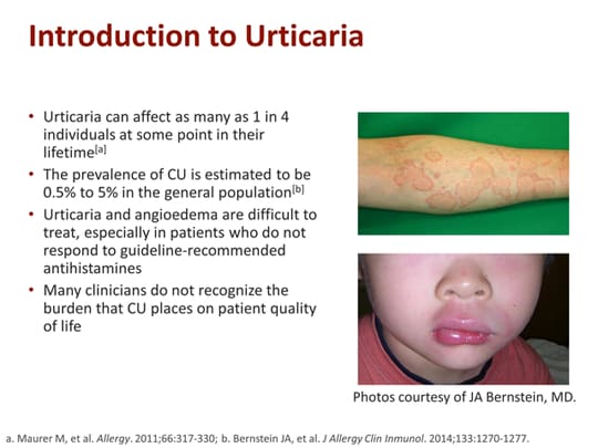 Chronic Idiopathic Urticaria: Improving Patient Outcomes and Quality of ...