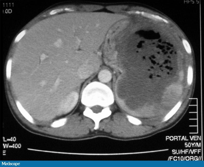 A Soccer Player With Abdominal Pain and Fever - Page 2