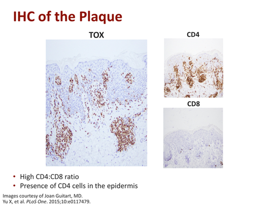 Initial Diagnosis of MF-CTCL: A Collaborative Approach (Transcript)