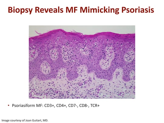 Initial Diagnosis of MF-CTCL: A Collaborative Approach (Transcript)