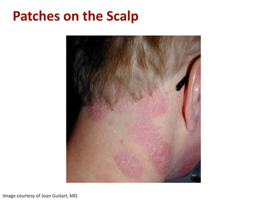 Initial Diagnosis of MF-CTCL: A Collaborative Approach (Transcript)