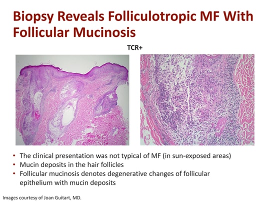 Initial Diagnosis of MF-CTCL: A Collaborative Approach (Transcript)