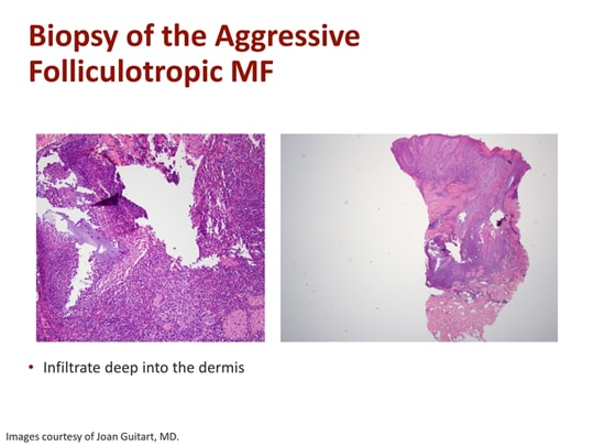 Initial Diagnosis of MF-CTCL: A Collaborative Approach (Transcript)