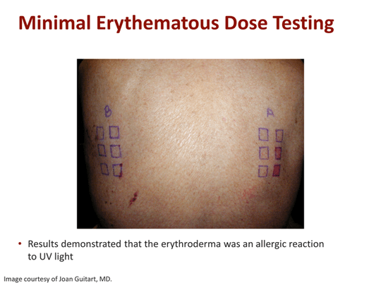 Initial Diagnosis of MF-CTCL: A Collaborative Approach (Transcript)
