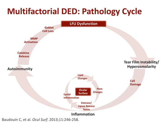 Advances in Dry Eye: Where Are We Now? (Transcript)