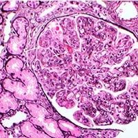 How I Treat Cryoglobulinemia
