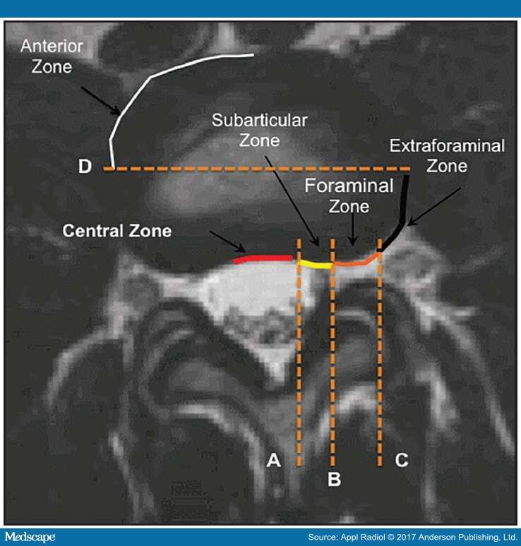 Imaging Spinal Stenosis