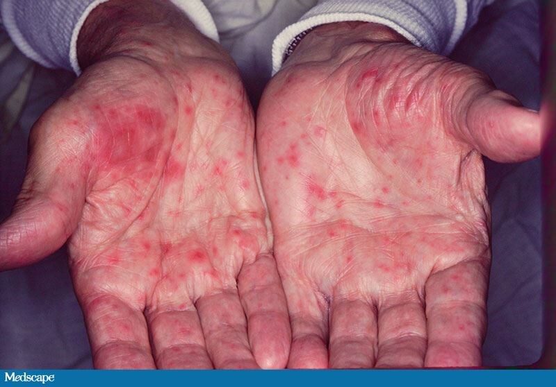 A 75-Year-Old Woman With Fever, Rash, and Skin Pain - Page 2