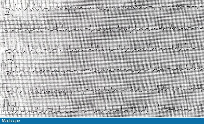 ECG Challenge: 'Doc, My Heart Is Racing--Again'