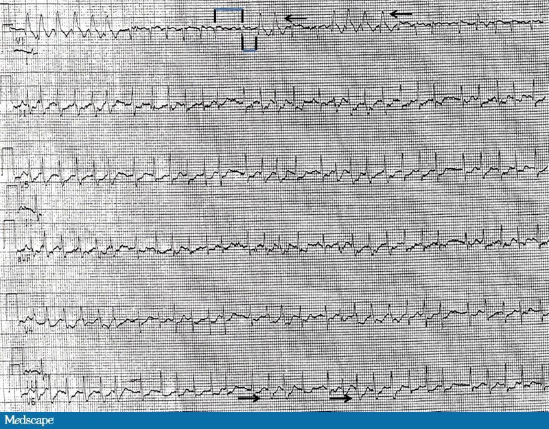 ECG Challenge: 'Doc, My Heart Is Racing--Again' - Page 2