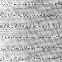 ECG Challenge: 'Doc, My Heart Is Racing--Again'