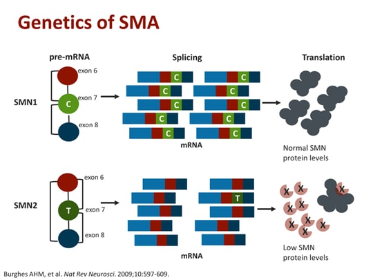 Optimal Management of Spinal Muscular Atrophy (Transcript)