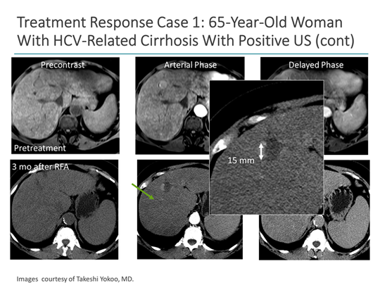 A Review of the Critical Role of Imaging in Primary Liver Malignancy ...
