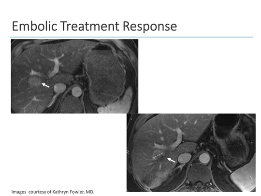 A Review of the Critical Role of Imaging in Primary Liver Malignancy ...
