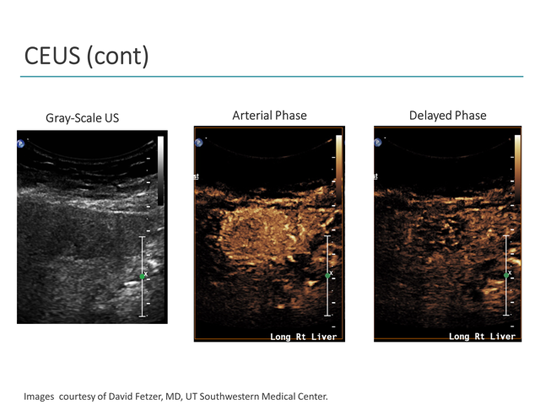 A Review of the Critical Role of Imaging in Primary Liver Malignancy ...
