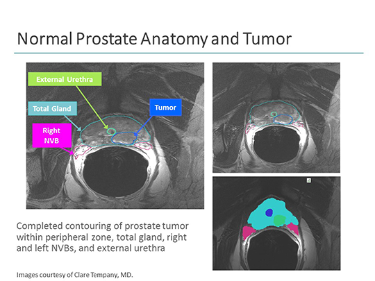 Strategies for Improving Diagnosis and Risk Stratification in Prostate ...