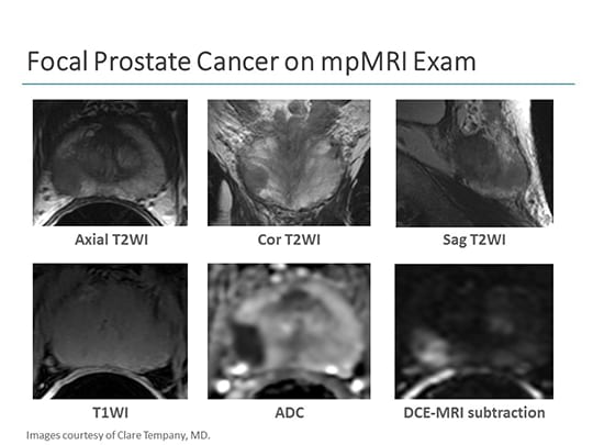 Strategies for Improving Diagnosis and Risk Stratification in Prostate ...