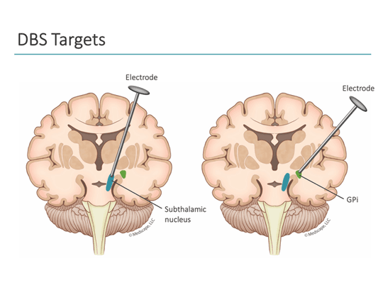 Practical Perspectives in the Surgical Management of Parkinson Disease