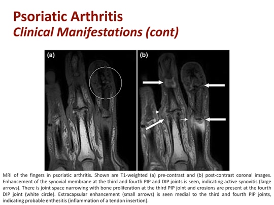 Effective Management of Psoriatic Arthritis: Tailoring Treatments (Transcript)