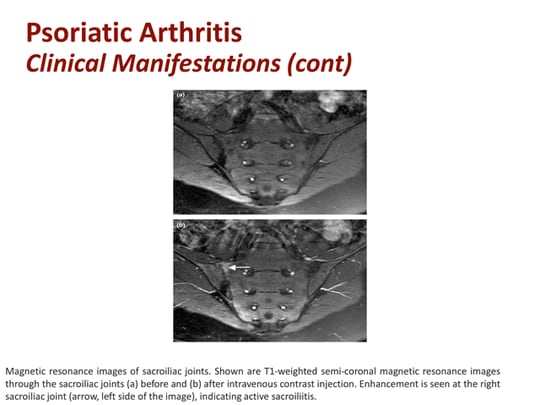 Effective Management of Psoriatic Arthritis: Tailoring Treatments (Transcript)