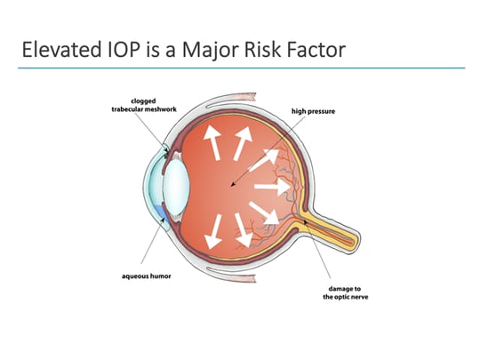 Glaucoma: Pearls for Screening, Diagnosis, and Comprehensive Management ...