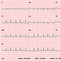 ECG Challenge: The Double-Double