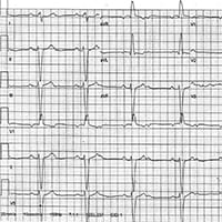 ECG Challenge: While He Was Sleeping…