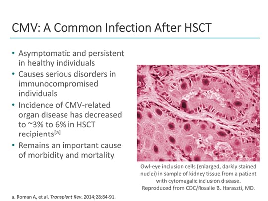 Management of CMV in HSCT Recipients (Transcript)