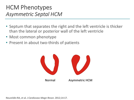 Latest Advances in HCM: Disease, Diagnosis, and Drug Development ...