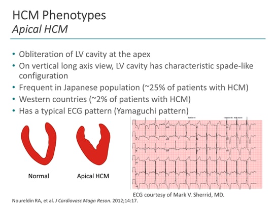 Latest Advances in HCM: Disease, Diagnosis, and Drug Development ...