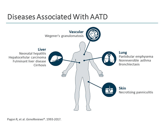 Alpha-1 Antitrypsin Deficiency in COPD: Advances in Biomarkers and ...