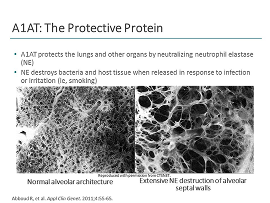 Alpha-1 Antitrypsin Deficiency in COPD: Advances in Biomarkers and ...