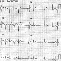 ECG Challenge: Palpitations With a Gallbladder Attack