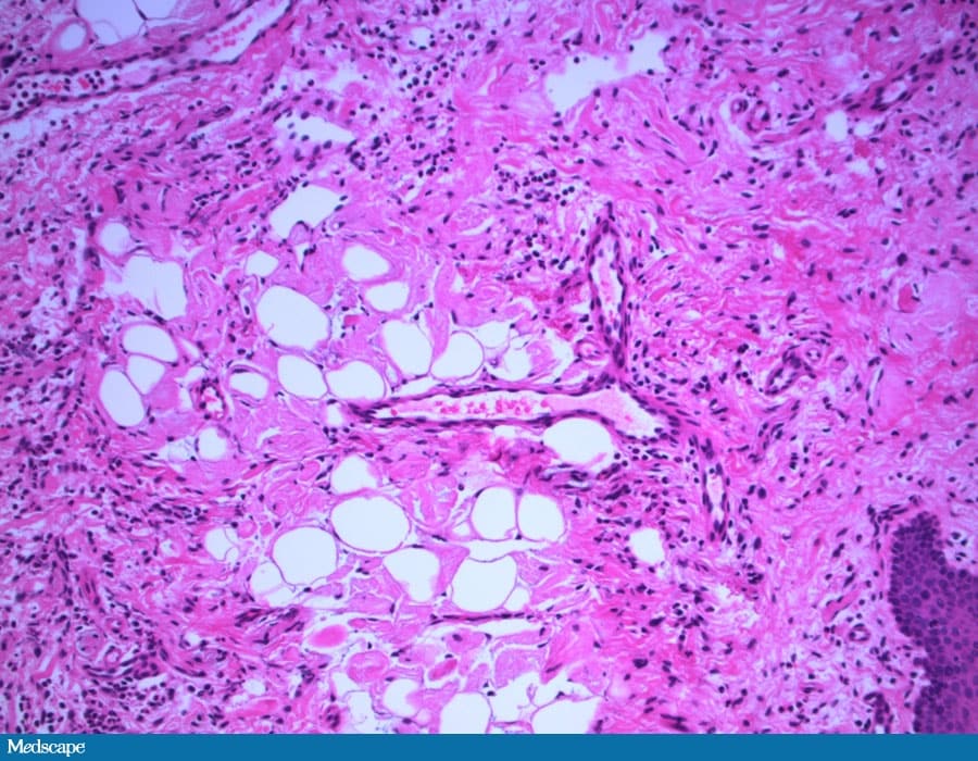 Loss of Taste, Rash, and Dyspnea in a 46-Year-Old With GERD - Page 3