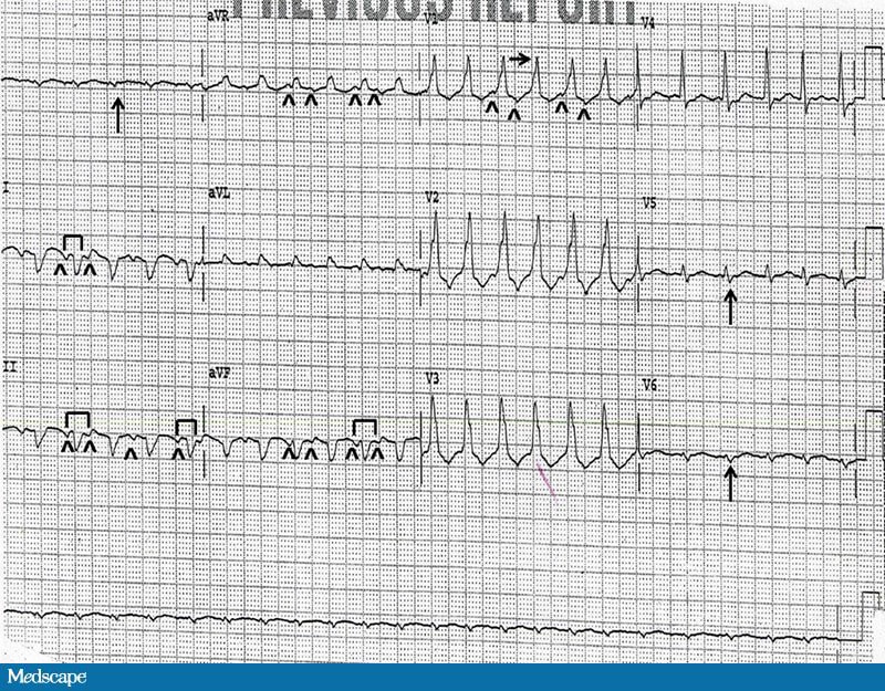 ECG Challenge: What Happened After CABG? - Page 2