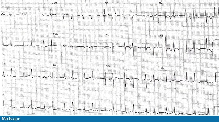 ECG Challenge: A Hypertensive Crisis